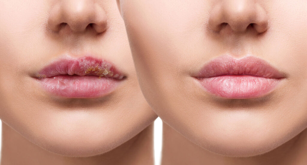 Opryszczka wargowa – nawracający problem - Farmacja Praktyczna